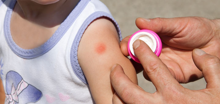 DIY Anti-Itch Bug Bite Sticks - Dherbs.com - Articles