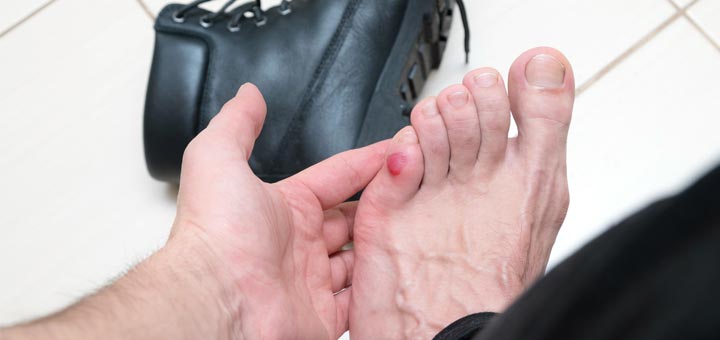 What To Do And What Not To Do For Blood Blisters - Dherbs.com - Articles